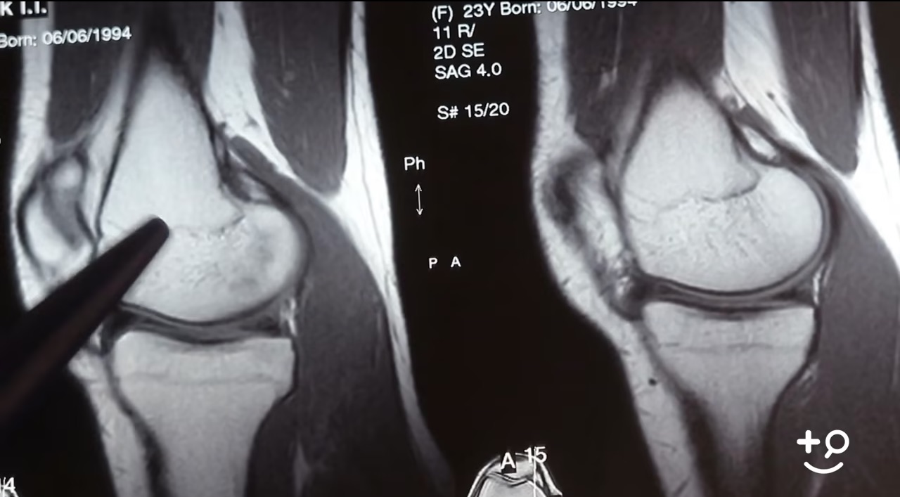 Knee Replacement - Femoral Component - Doctorpedia