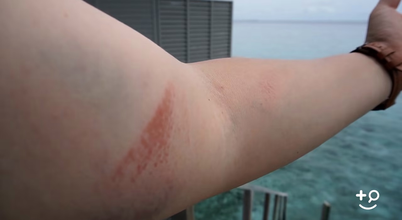 Simple Burn - Overview - Doctorpedia Doctor-Reviewed Video