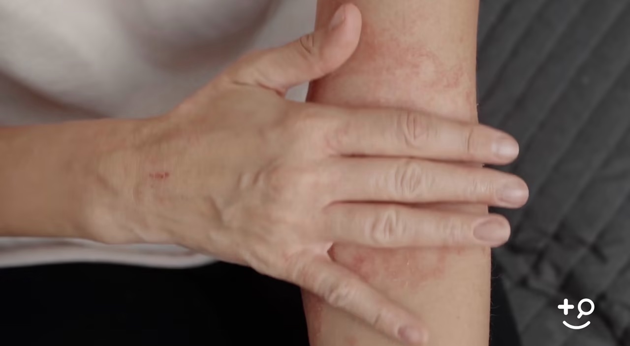 Hives - Overview - Doctorpedia Doctor-Reviewed Video