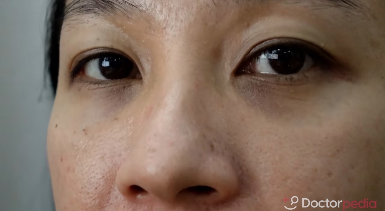 Tinea Versicolor - Causes - Doctorpedia Doctor-Reviewed Video