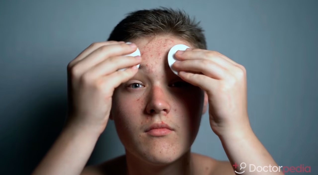 Acne - Prevention - Doctorpedia Doctor-Reviewed Video