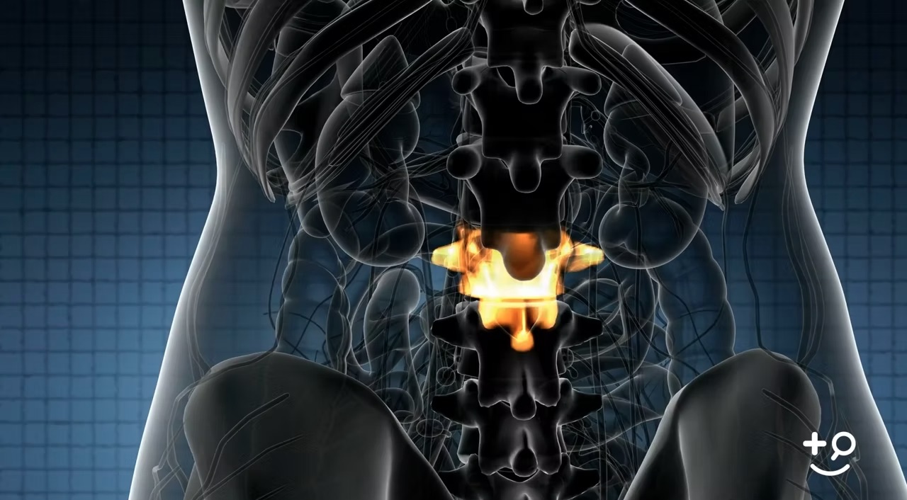 Sciatica - Overview - Doctorpedia Doctor-Reviewed Video