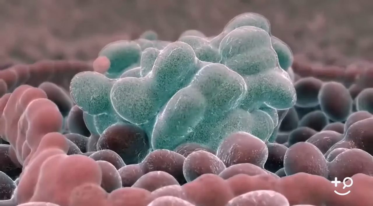 Colon Cancer - Polyp - Definition - Doctorpedia Doctor-Reviewed Video